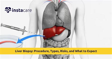 Percutaneous Liver Biopsy Technique Biopsy Of Liver Via