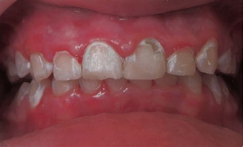 Advanced White Spot Lesions In A Patient After The Completion Of Download Scientific Diagram