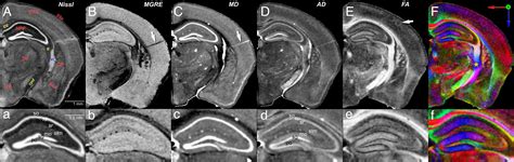 Dentate Gyrus Mri