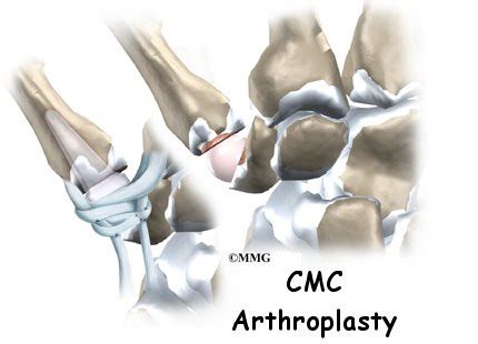 Artificial Joint Replacement Of The Thumb