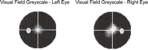 Visual Fields Of Patient During Presentation Upon Presentation For A Download Scientific
