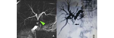 3d Mrcp A Post Cholecystectomy Showing Abrupt Arrest Of The Chd About