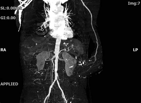Ct Angiogram Of Aorta And Left Upper Exterimity Download Scientific