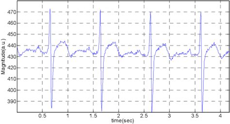 figure 2 from a assessment of multiscale based peak detection algorithm