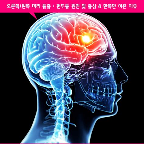 오른쪽왼쪽 머리 통증 편두통 원인 및 증상 And 한쪽만 아픈 이유 네이버 블로그