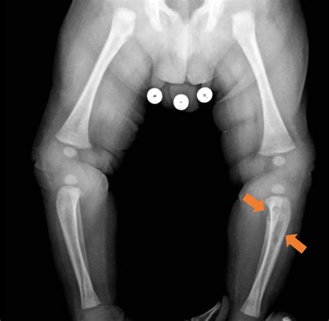Bone Radiograph Shows 2 Gross Intraosseous Osteolytic Areas In The