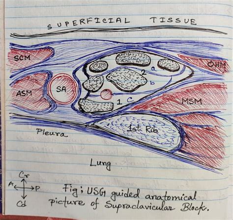 Supraclavicular Block Usg Guided Diagram Draw By Me 🩺 Ayub Laskar