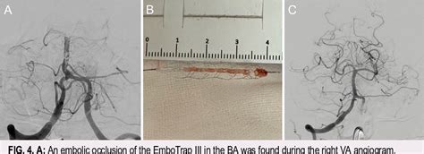 Figure 4 From Novel Use Of A Closed Tip Stent Retriever To Prevent Distal Embolism In The