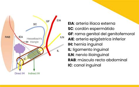 Anatomía De La Hernia Inguinal Directa E Indirecta Cuáles Son Los