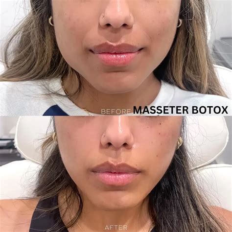 Masseter Botox Before And After Before After Journey