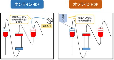 オンラインhdfとオフラインhdfの違い 臨床工学技士の熱血透析blog