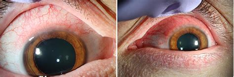 Limbic Sparing Injection