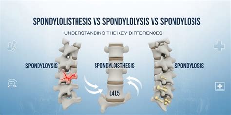 Spondylolisthesis Spondylolysis And Spondylosis Key Differences