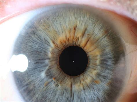 Modern And Multidimensional Iridology Atrophy Of The Ipb Stomach Ring