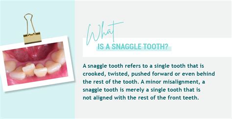Fixing Snaggle Tooth With Invisible Aligners Ez Smile
