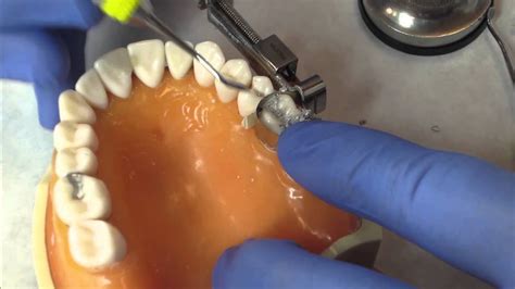 Classification Of Amalgam Restoration At Anthony Latisha Blog