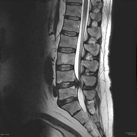 Neural Foraminal Stenosis Mri