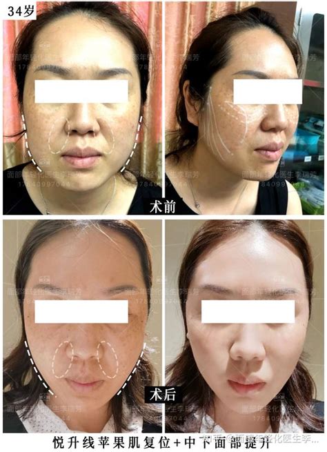 悦升线苹果肌复位中下面部提升1个半 知乎