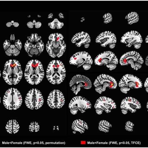 Distribution Of Volumes Of Corpus Callosum Cc Among 37 Man Woman
