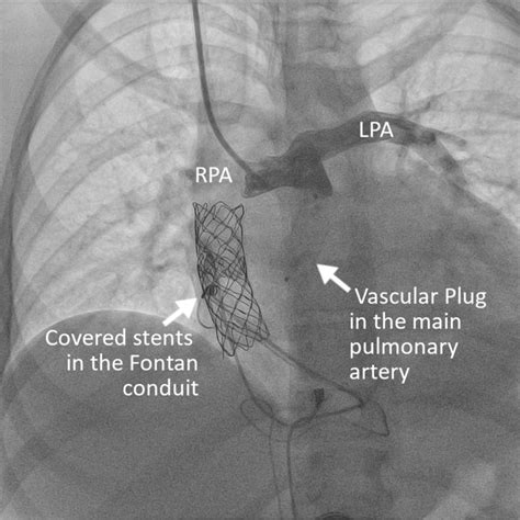 Angiogram At The End Of The Procedure Fontan Conduit After Stenting Download Scientific