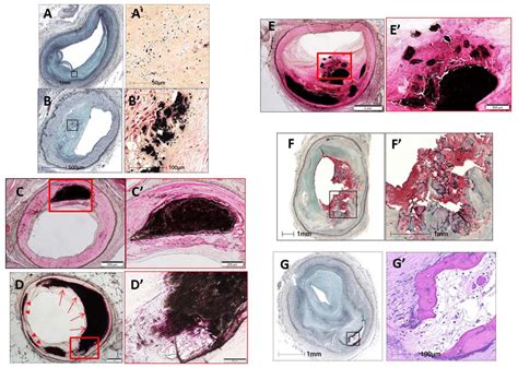 A Progression Of Intimal Calcification In Lower Extremity Peripheral Download Scientific
