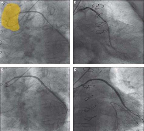 Radial Artery Spasm And Abnormal Flow Reserve Thoracic Key