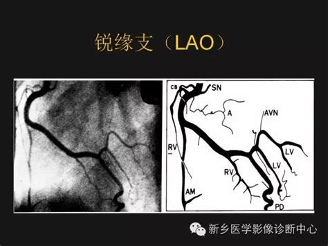 冠状动脉解剖精细到每一个分支 好医术文章 好医术 赋能医生守护生命