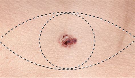 Skin Cancer Excision Cutexx Skincare