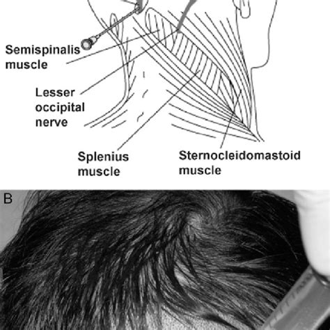 Occipital Nerves Block A This Diagram Illustrates Greater Occipital
