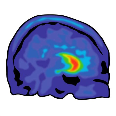 Creating An Information Leaflet For Fdopa Pet Imaging Graphical Science