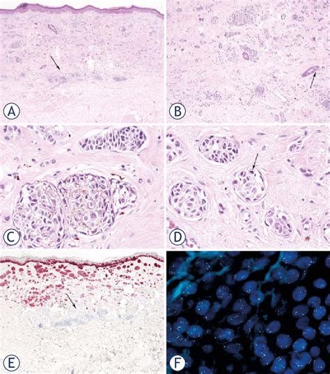 sclerosing melanoma from the abdomen of a 67 year old man a there