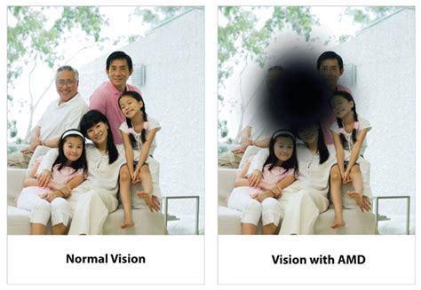 Age Related Macular Degeneration Amd Treatment Puerto Vallarta