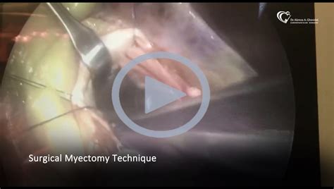 Surgical Myectomy Technique Doctorghavidel