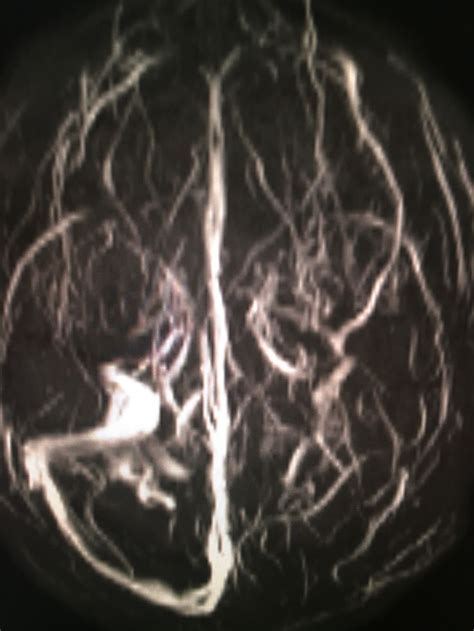 Left Transverse And Sigmoid Sinus Thrombosis Sinusitis Thrombosis