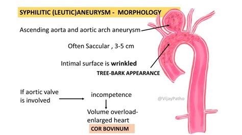Tree Bark Aorta