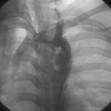 Hemashield Y Graft Was Implanted To Descending Aorta With End To Side