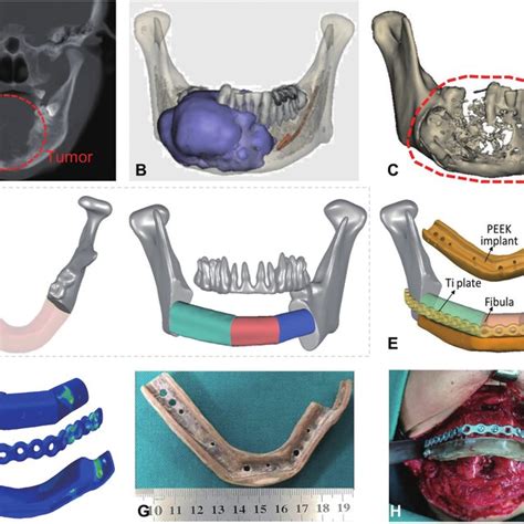 3d Printed Peek Femoral Segmental Prosthesis A 3d Model Of The Femur Download Scientific