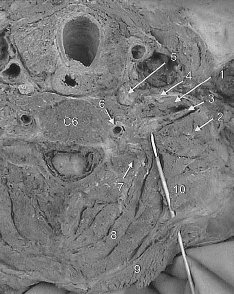 Oblique Transection Of The Neck At The Level Of C6 The Section Is From Download Scientific