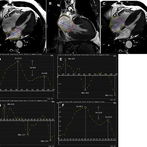 representative hcm example for bi atrial cmr feature tracking analysis