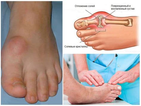 Причины появления косточки на большом пальце ноги Медицинский центр Эра
