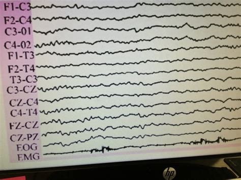 Lab Quiz 9 EEG Flashcards Quizlet