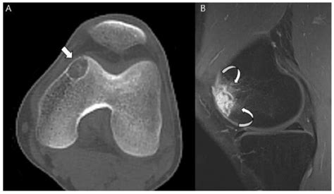 Classification Of Chondrosarcoma From Characteristic To Challenging