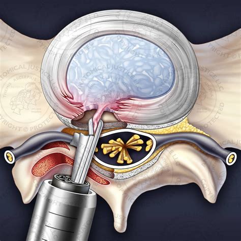 Endoscopic Lumbar Discectomy Disc Herniation At Aidan Zichy Woinarski Blog