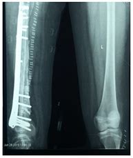 Bone Sarcomas Proton Therapy
