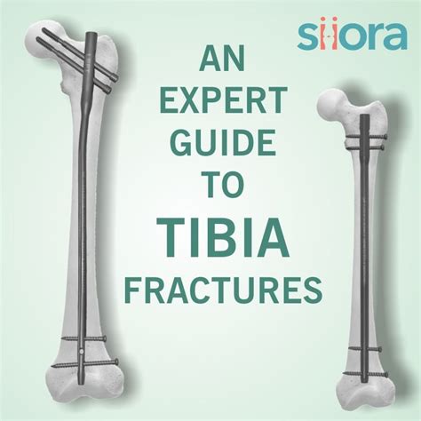 Tibia Fractures An Experts Guide