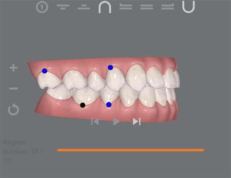What Are These Dots On Clincheck R Invisalign