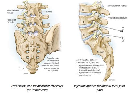 Spinal Facet Injections