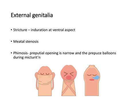 Acute And Chronic Urinary Retentionpptx