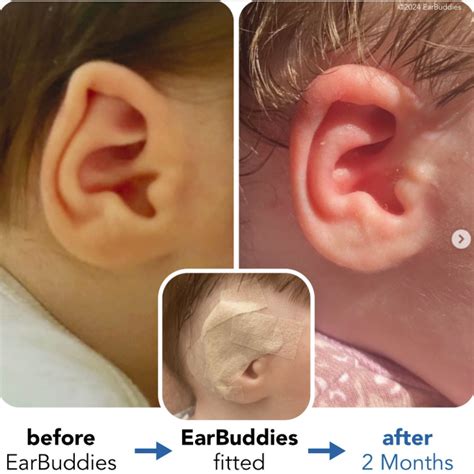 Earspot™ Ai Ear Shape Assessment