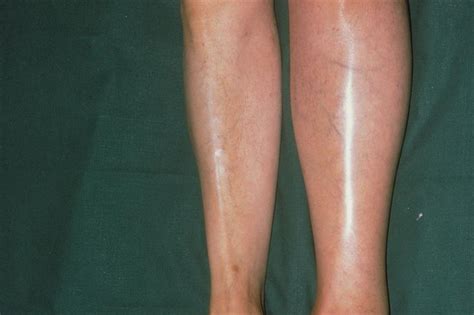Differentiating Between Red Legs And Cellulitis